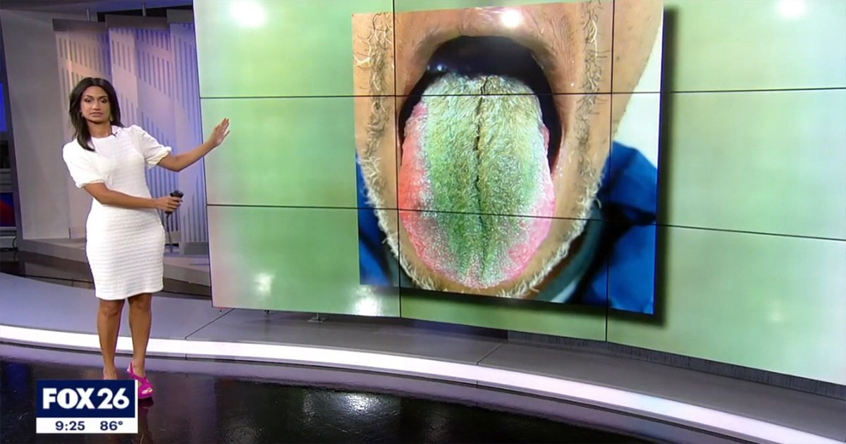 Smoker’s Tongue Sprouts Green Hair After Years Of Smoking Cigarettes